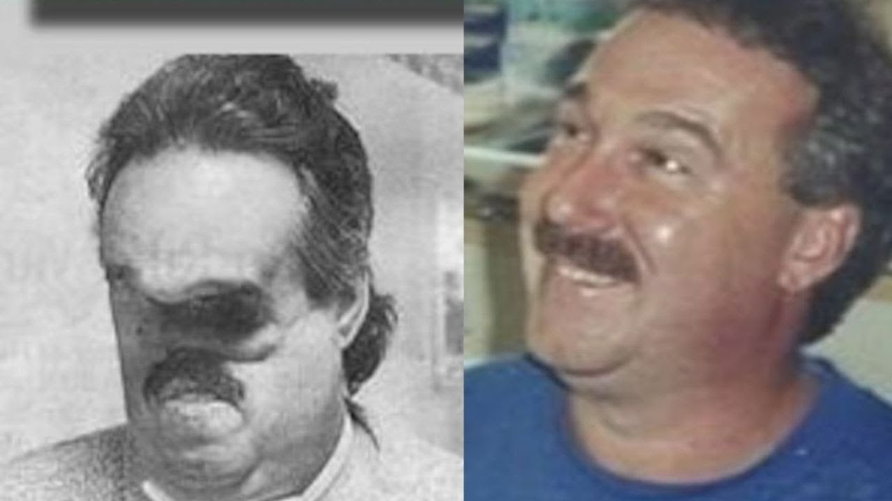 Fungal Infection Awareness & Mold Remediation - Protect Your Home & Family